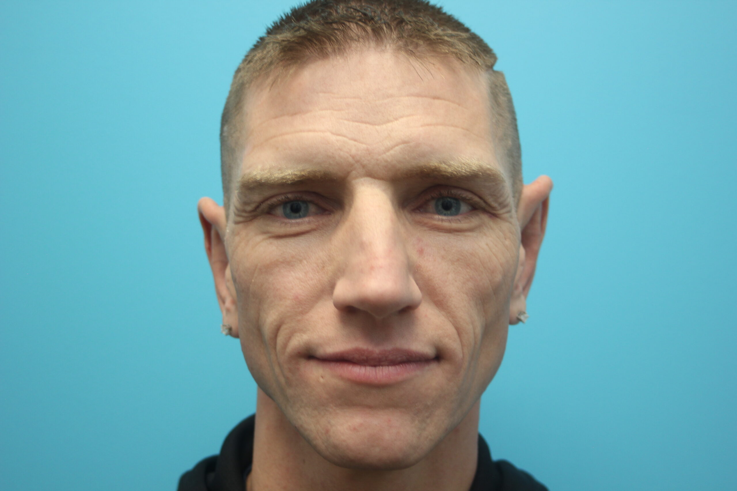 Gallery of Facial procedures - Modern Surgical Arts of Denver