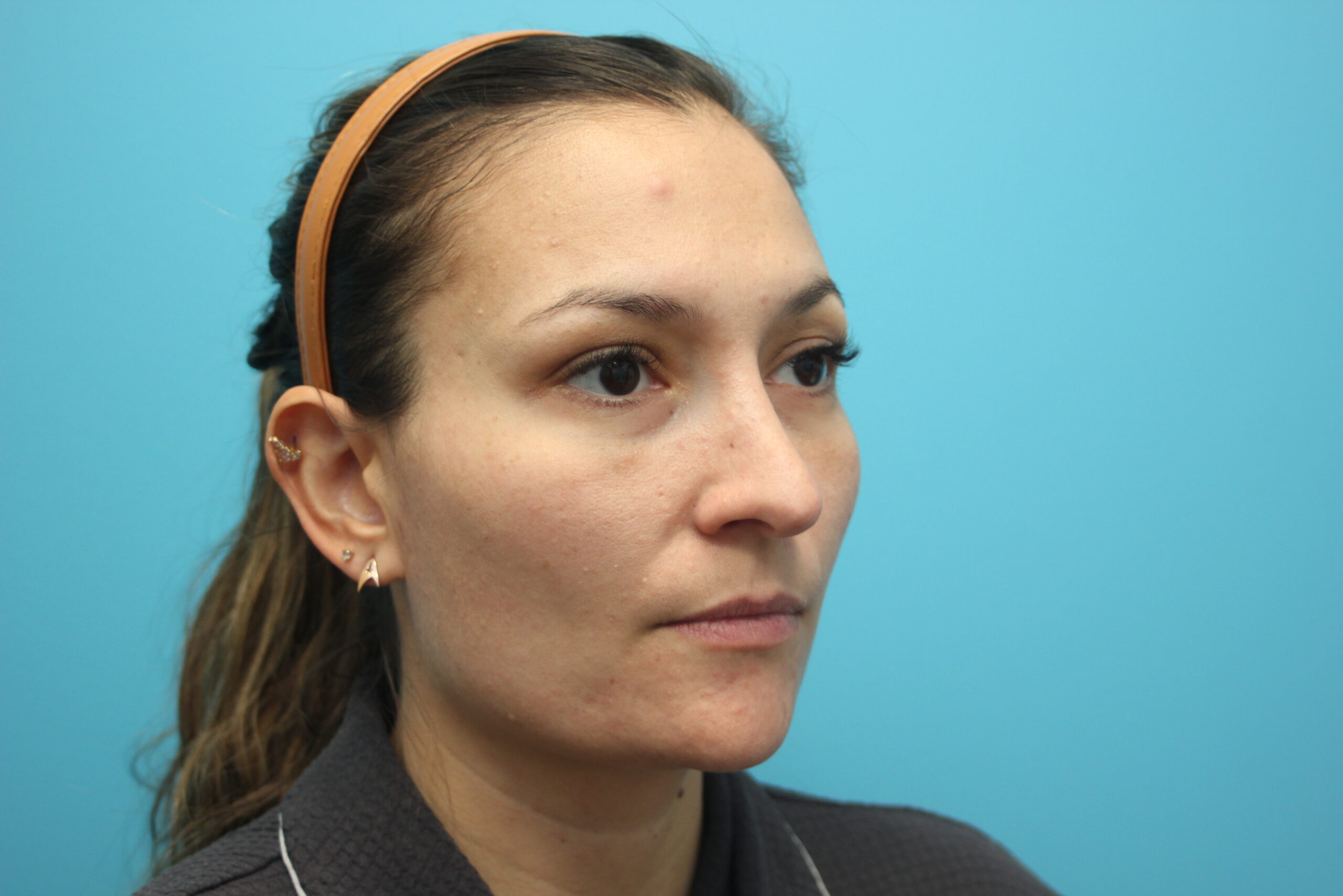 Gallery of Facial procedures - Modern Surgical Arts of Denver