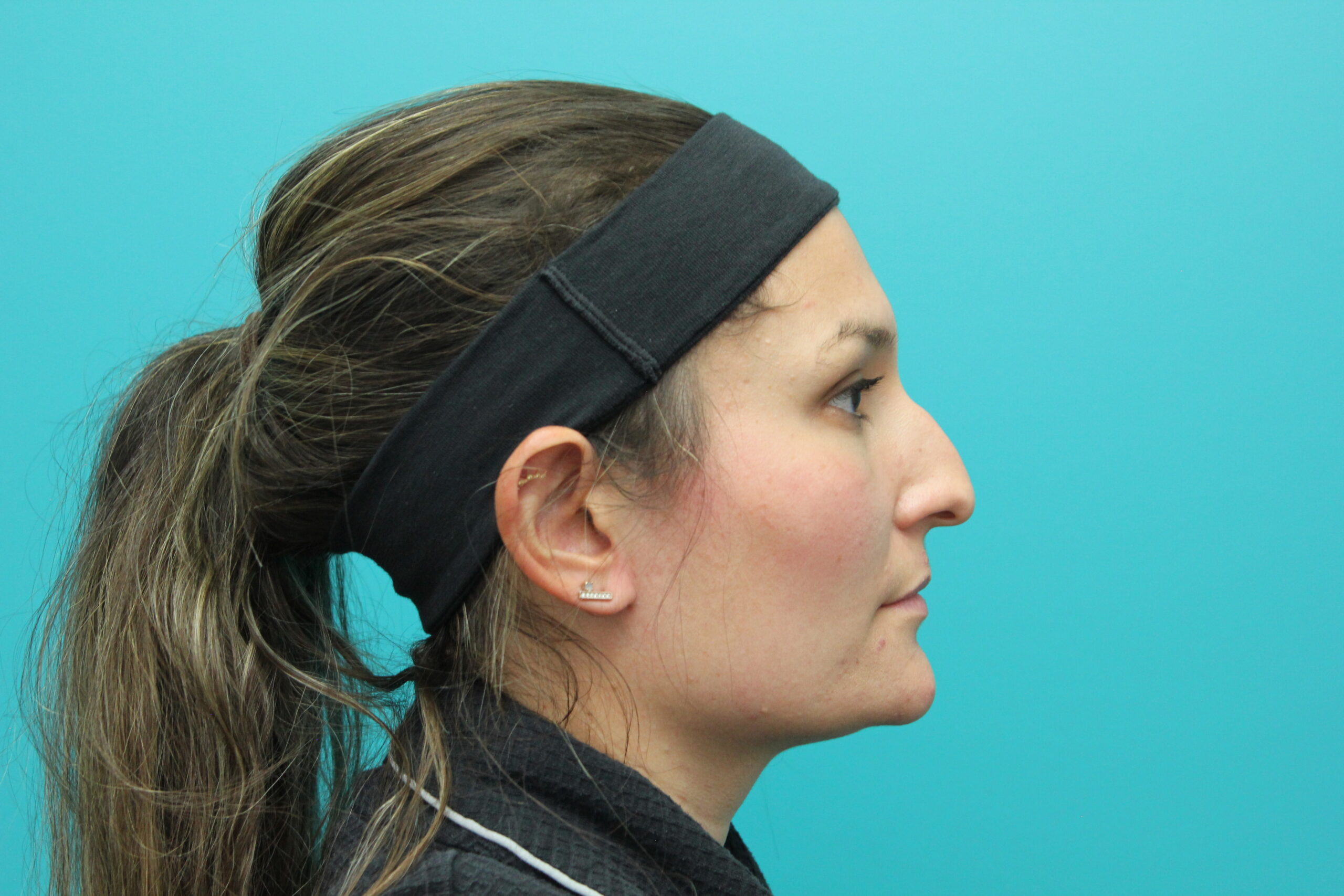 Gallery of Facial procedures - Modern Surgical Arts of Denver