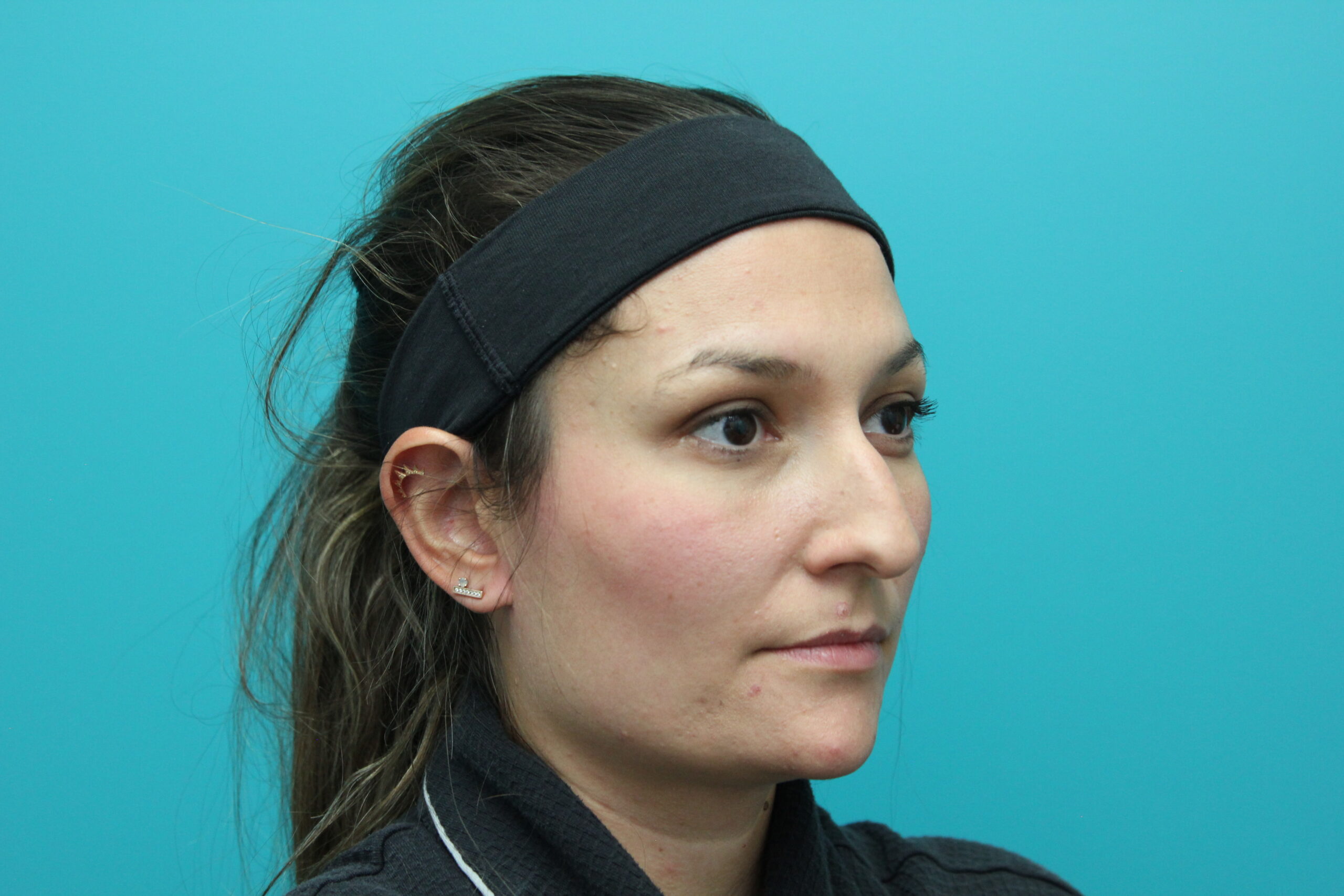 Gallery of Facial procedures - Modern Surgical Arts of Denver