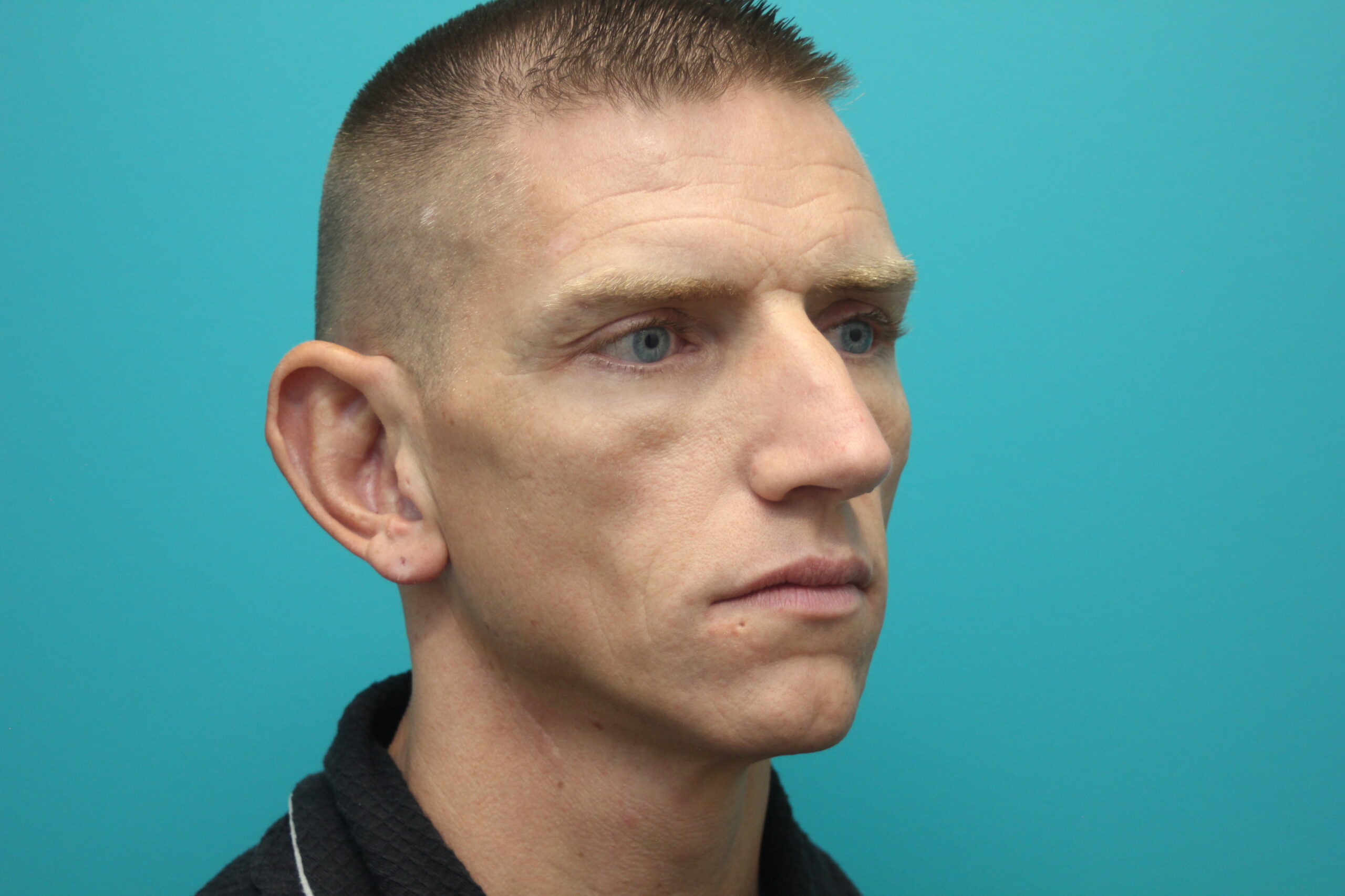 Gallery of Facial procedures - Modern Surgical Arts of Denver